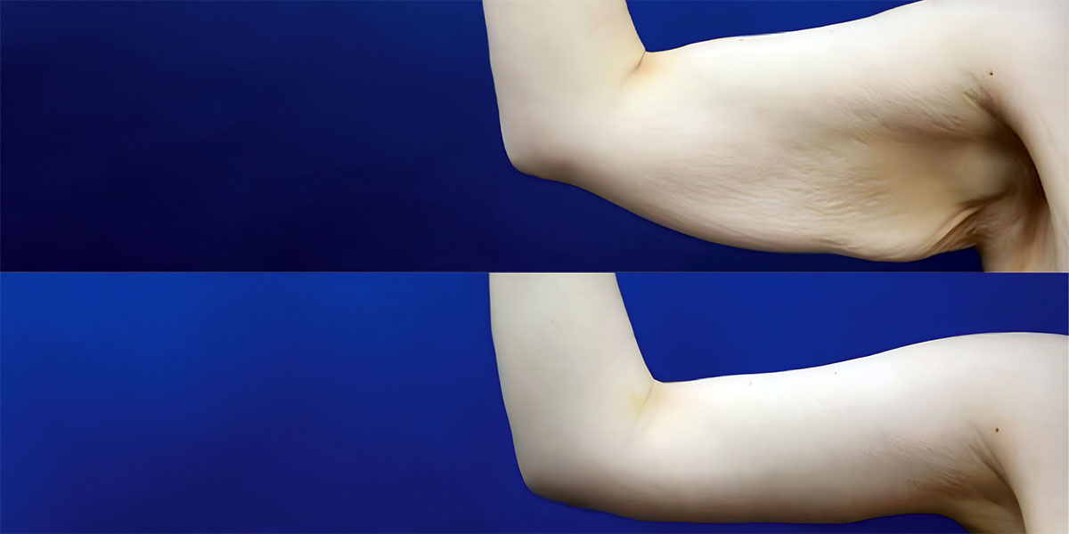 Arm Liposuction: Your Ticket to Toned Arms - Liposuction Facts